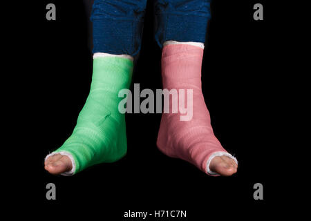 Young man with two broken ankles and dual white casts on his legs ...