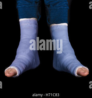 Legs of a man with a broken leg on a blue background. X-ray image of ...