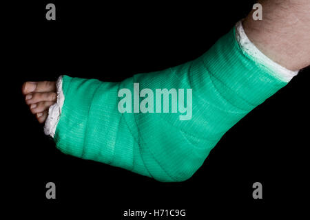 Close up of a fiberglass / Plaster leg cast and toes Stock Photo ...