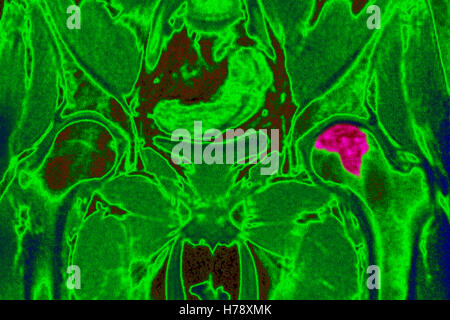 HIP OSTEOARTHRITIS, MRI Stock Photo - Alamy