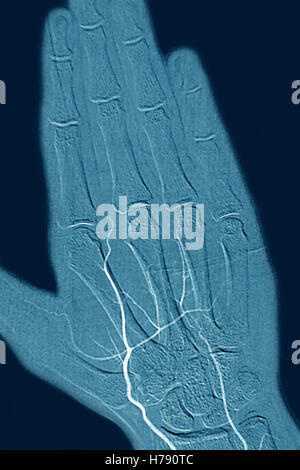 UPPER LIMB, ANGIOGRAPHY Stock Photo - Alamy