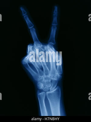Peace hand gesture, X-ray Stock Photo - Alamy