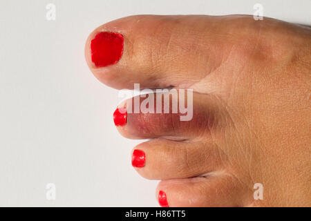 A bruised big toe on the left foot of a Caucasian male with grey ...