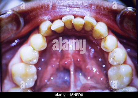 Dentists dental tooth photograph showing tooth non aligned front teeth ...