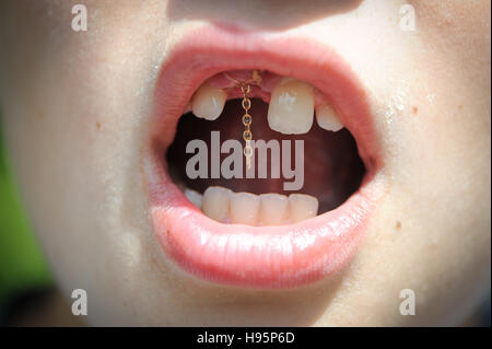 A young boy after having a chain fitted in surgery on tooth to attach ...