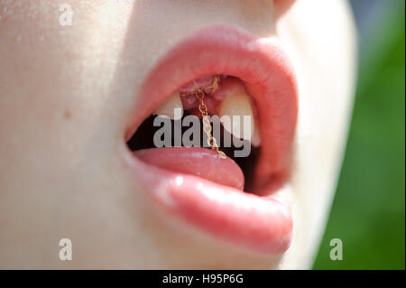 A young boy after having a chain fitted in surgery on tooth to attach ...
