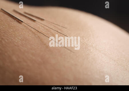 Close-up of needles for dry needling on skin Stock Photo - Alamy