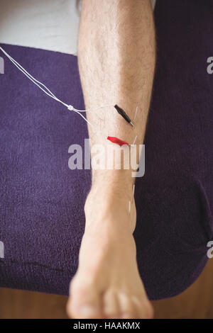 Patient getting electro dry needling on his back Stock Photo - Alamy