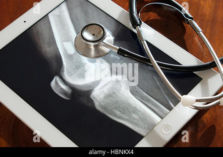 x-ray image on ipad tablet screen monitor of leg femur Stock Photo - Alamy