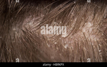 close up shot of a dandruff Stock Photo - Alamy