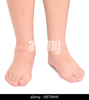EDEMA OF THE LEG Stock Photo: 49286522 - Alamy