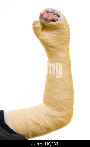 Close up of a young man's fiberglass / Plaster leg cast and toes after ...