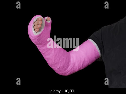 A pink long arm plaster / fiberglass cast covering the wrist, arm, and ...