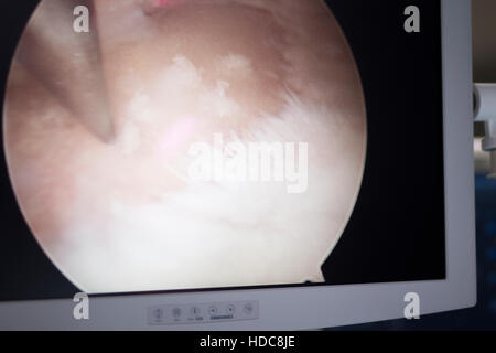 Arthroscopy surgery screen showing arthroscope camera picture in knee ...