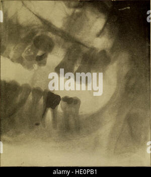 Mouth hygiene and mouth sepsis (1912 Stock Photo - Alamy