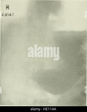 Cancer of the stomach; a clinical study of 921 operatively and ...