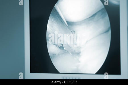 Arthroscopy surgery screen showing arthroscope camera picture in knee ...