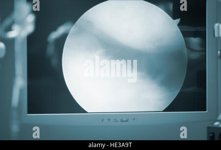 Arthroscopy surgery screen showing arthroscope camera picture in knee ...