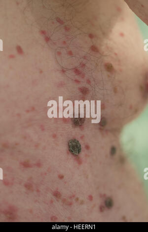 Mans back with mass of moles and infection Stock Photo - Alamy