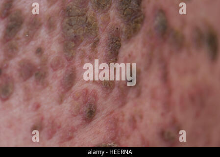 Mans back with mass of moles and infection Stock Photo - Alamy