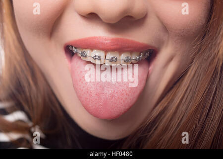 Closeup of a mouth with braces on teeth and the tongue out, isolated in ...