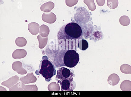 Megakaryocytes in MDS (RAEB and 5q-chromosome abnormality Stock Photo ...