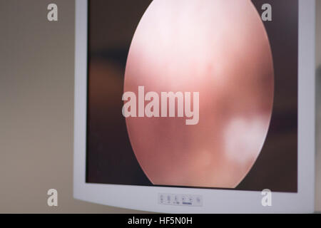 Arthroscopy surgery screen showing arthroscope camera picture in knee ...