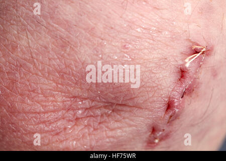 dissolvable stitches in an elbow surgical wound to correct cubital ...