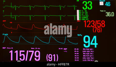 Monitor with ECG with paced heart rhythm, arterial blood pressure ...