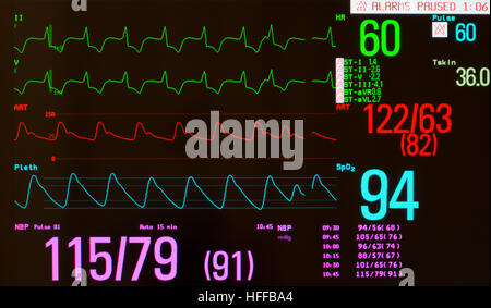 Monitor with ECG with paced heart rhythm, arterial blood pressure ...
