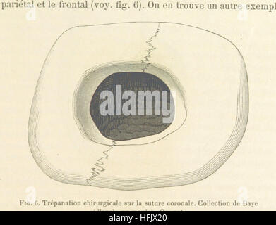 A study on cranial trepanation and the use of cranial amulets during ...