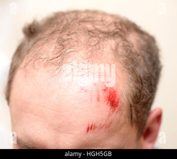 abrasion on forehead men Stock Photo - Alamy