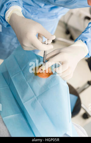 Laser eye surgery. Elderly man having a blue argon laser shone into his ...