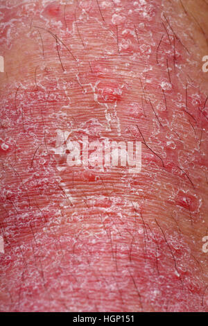 Plaque psoriasis. Close-up of dry scaly lesions on the skin of a 68 ...