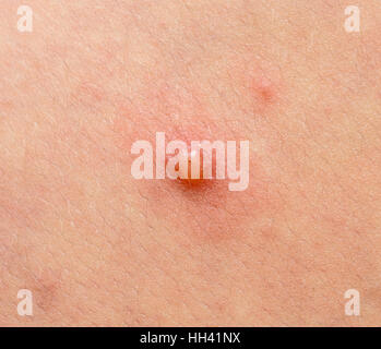 Shingles, Zoster or Herpes Zoster symptoms on arm Stock Photo - Alamy