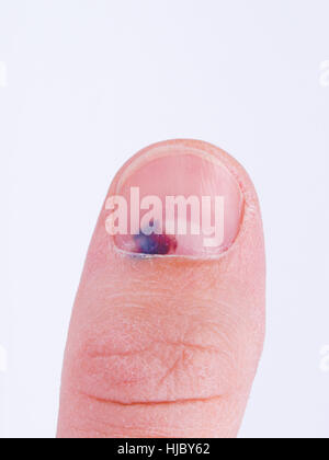 Subungual hematoma - collection of blood underneath fingernail (black ...