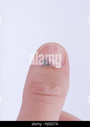 Subungual hematoma - collection of blood underneath fingernail (black ...