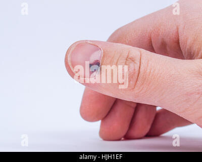 Subungual hematoma - collection of blood underneath fingernail (black ...