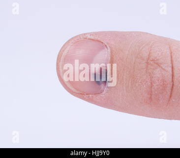 Subungual hematoma - collection of blood underneath fingernail (black ...