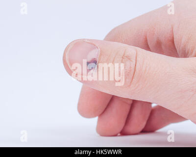 Subungual hematoma - collection of blood underneath fingernail (black ...