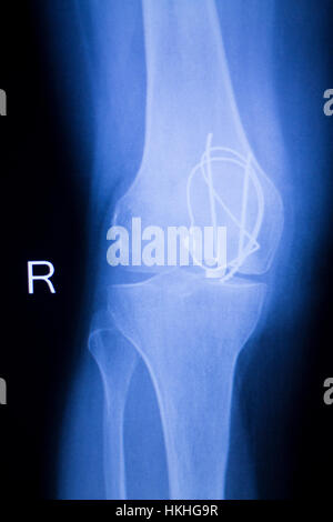 Knee joint implant wire xray showing in medical orthpodedic ...