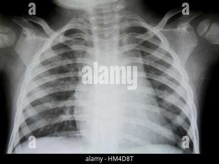 chest x-ray examination for diagnosis Pulmonary tuberculosis Stock ...