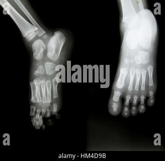 Medical hospital x-ray feet traumatology scan Stock Photo - Alamy