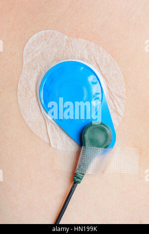 Woman Wearing Holter Monitor Device For Daily Monitoring Of An ...