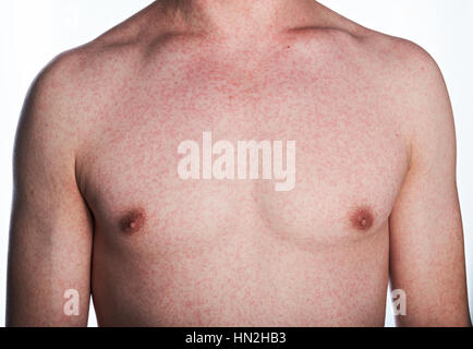 Skin reaction on a man chest after chemotherapy. Allergic reaction ...