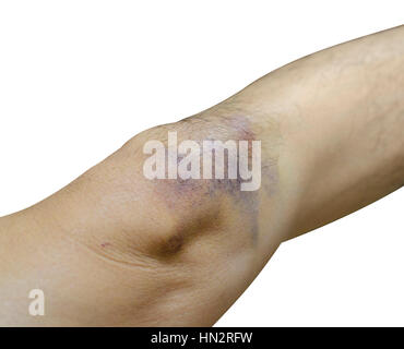 Bruises on skin of her leg Stock Photo - Alamy