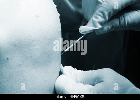 Surgical operation knee arthroscopy micro surgery on knee, tendon ...