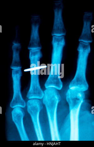Orthopedics Hand finger joint meniscus, ligament, tendon and cartilage ...