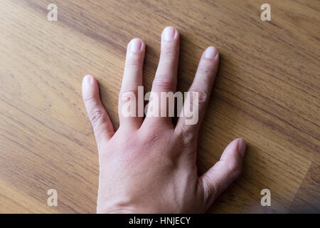 swollen hand from wasp insect sting Stock Photo: 133786886 - Alamy