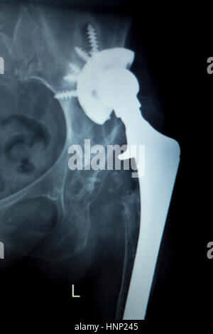 Titanium Hip Prosthetic Ball Joint Stock Photo - Alamy